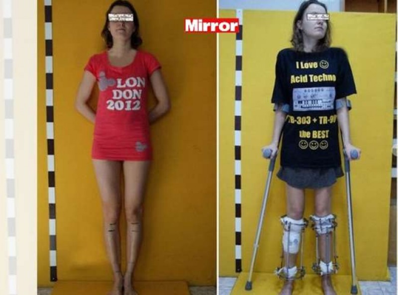 Operazione Dolorosissima per Allungarsi le Gambe. Più 6cm per Fare la ...
